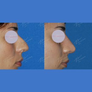 RINOPLASTIKA - tagad atkal iespējama pie mums - Aesthetica.lv